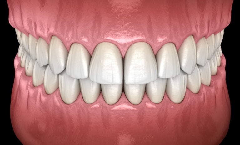 How Does My Bite Classification Impact My Orthodontic Treatment? - Love ...