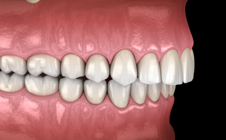 How Does My Bite Classification Impact My Orthodontic Treatment? - Love ...