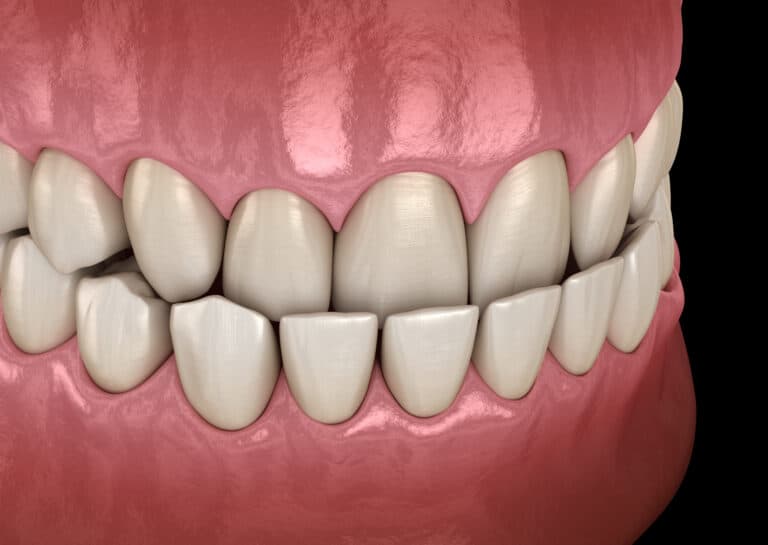 How Does My Bite Classification Impact My Orthodontic Treatment? - Love ...